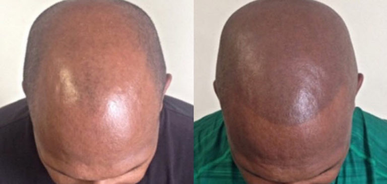 Hair and Scalp Pigmentation Before and After Pictures and Images