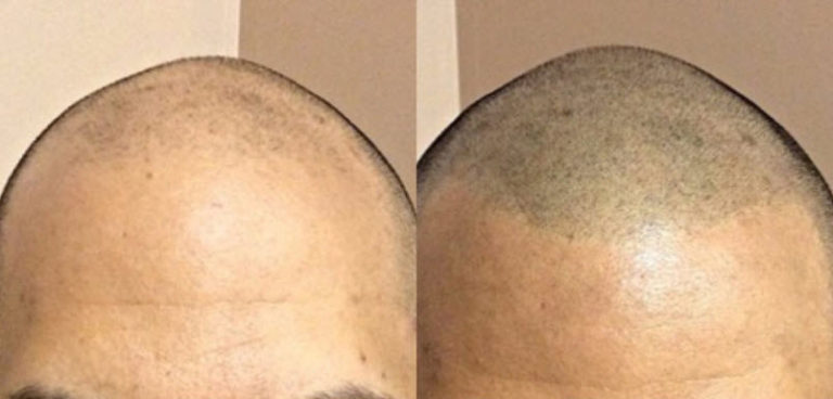 Hair and Scalp Pigmentation Before and After Pictures and Images