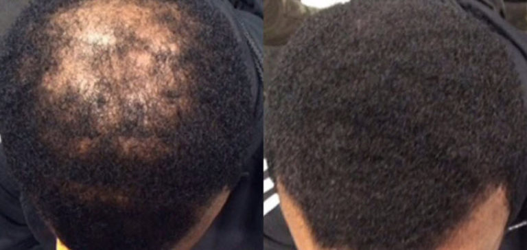 Hair and Scalp Pigmentation Before and After Pictures and Images