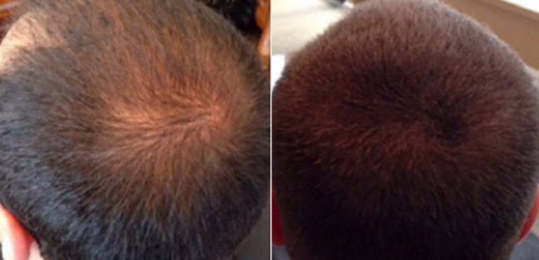 Hair and Scalp Pigmentation Before and After Pictures and Images